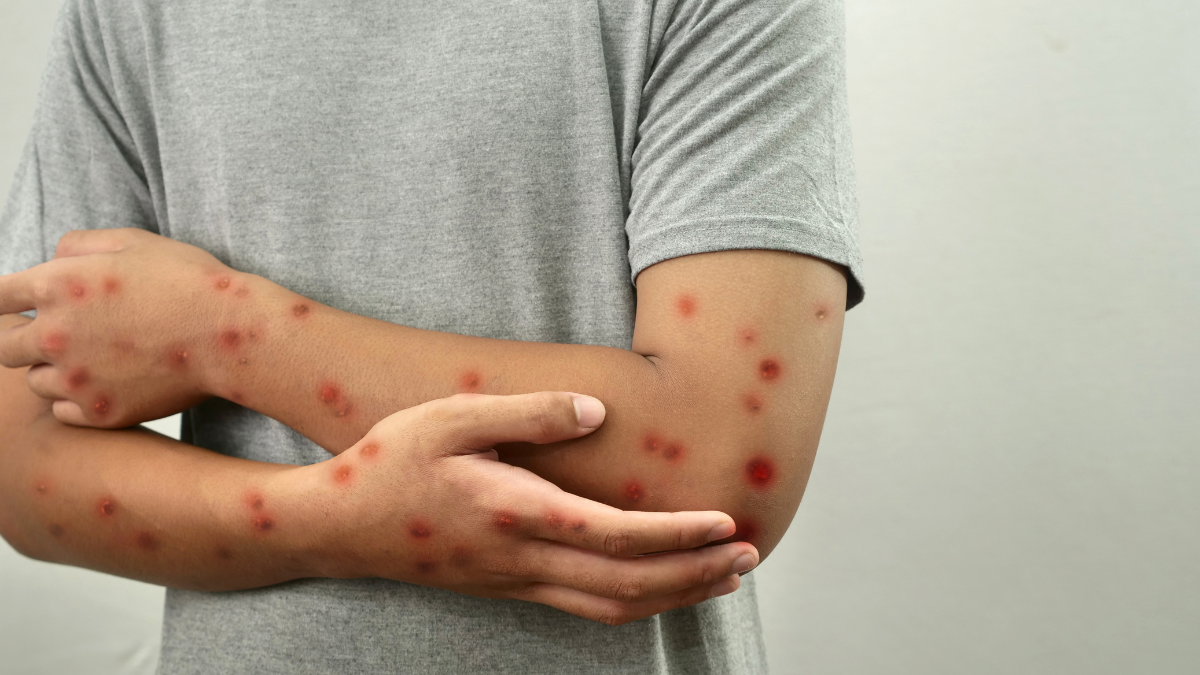 ¿Cuántos casos de viruela del mono hay confirmados en Chile y por qué ...